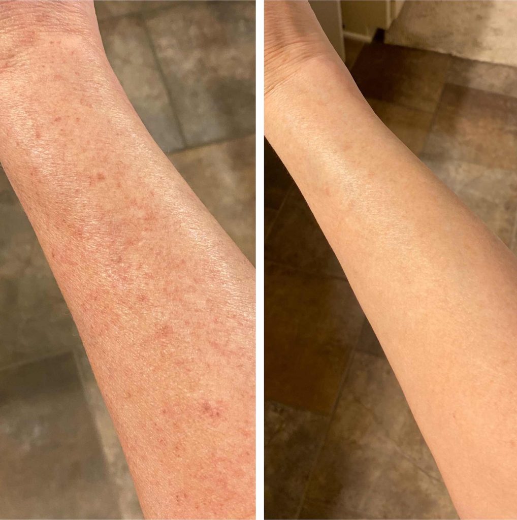 IPL Photofacial in Zachary | Renaissance Dermatology & Aesthetics