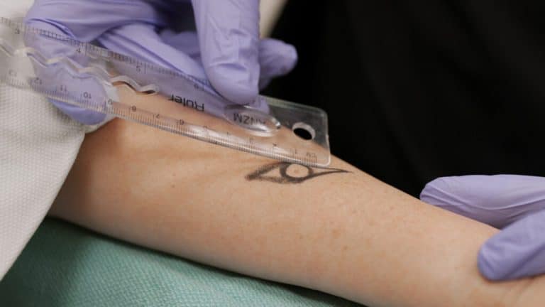 Skin Cancer Surgery | Renaissance Dermatology