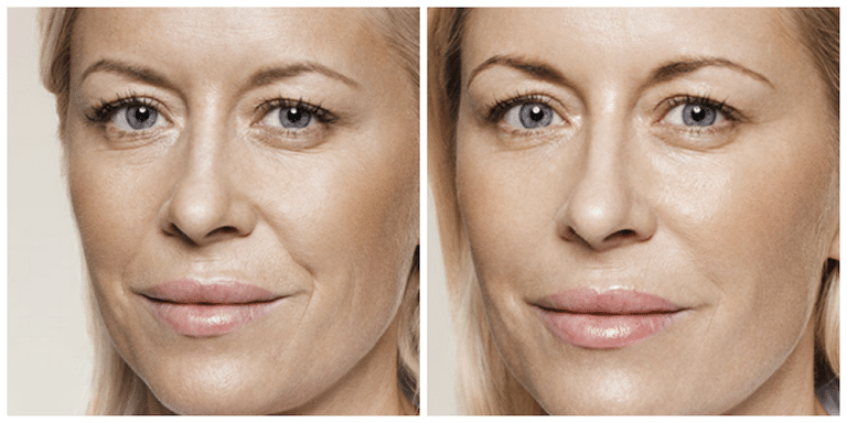 Restylane in Zachary | Renaissance Dermatology & Aesthetics
