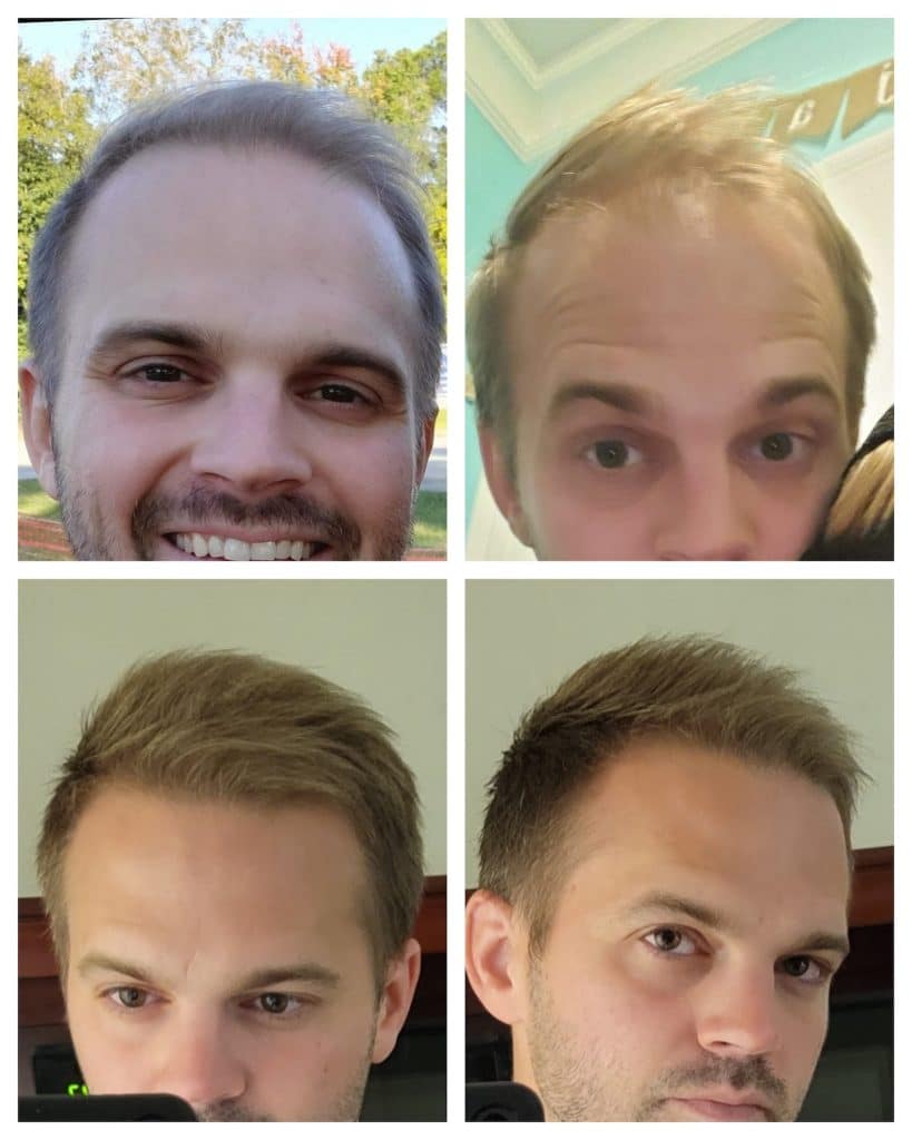 PRP Hair Restoration in Zachary | Renaissance Dermatology