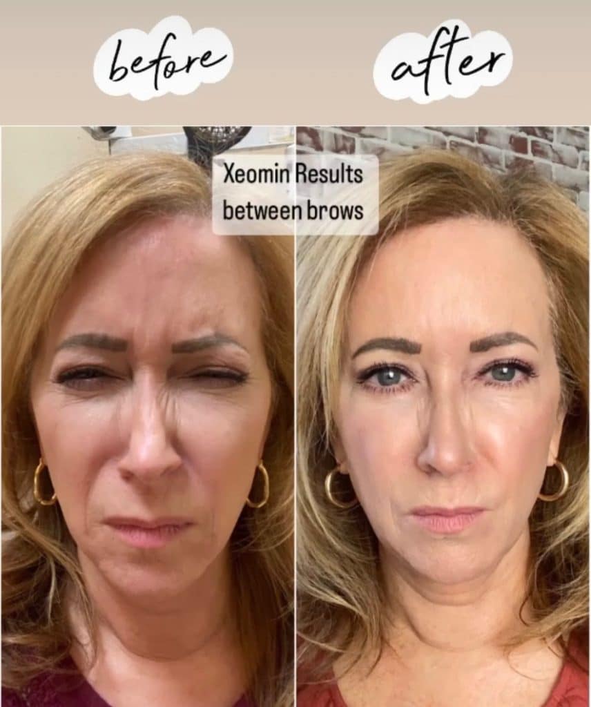 Xeomin in Zachary | Renaissance Dermatology & Aesthetics